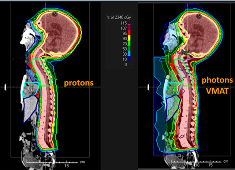 Medulloblastome schonend und effizient behandeln