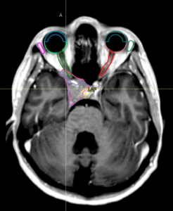 Hypophysenadenome & Hypophysenkarzinome